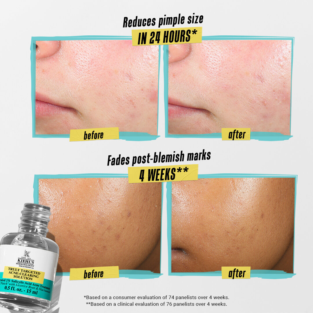 Truly Targeted Acne-Clearing Solution — Pimple Patch — Kiehl’s